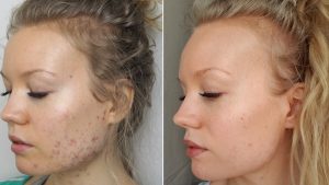 Skin update - 6 months of birth control pills for acne