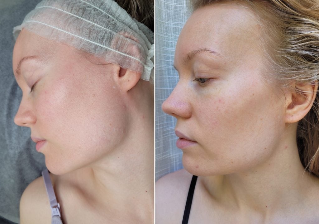 Dermapen microneedling results - Before & after - Charlotta Eve