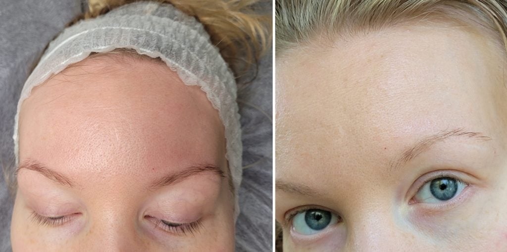 Dermapen microneedling results - Before & after - Charlotta Eve